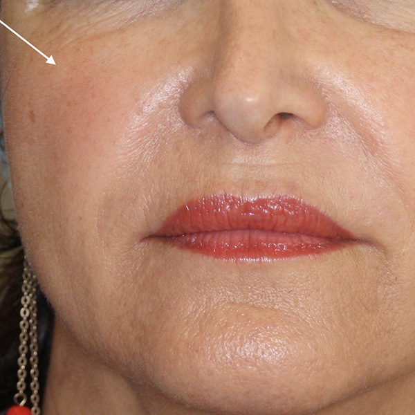 Photos avant après médecine esthétique