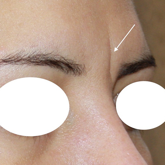 Injections acide hyaluronique