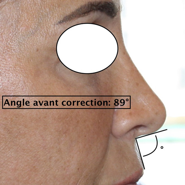 Photos avant après médecine esthétique